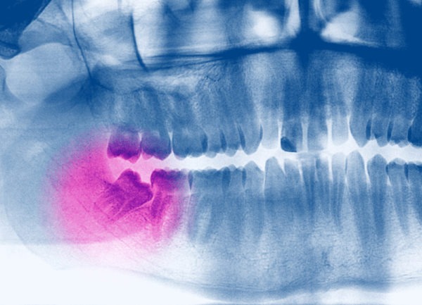 Reverse Impacted Wisdom Tooth